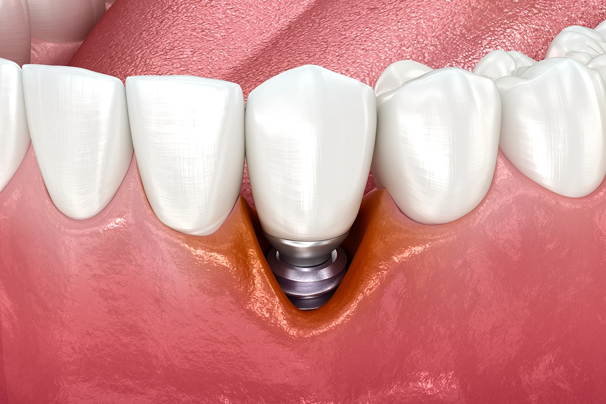 Therapieentscheid in der rekonstruktiven Periimplantitistherapie ...