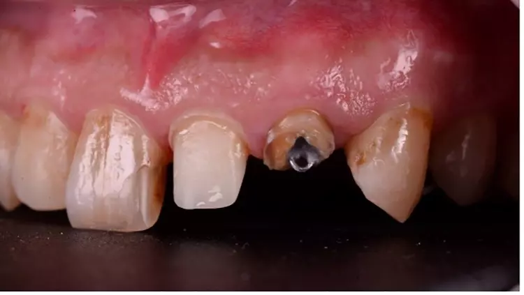 Präprothetische Extrusion und Glasfaserstiftaufbau | Dentalwelt