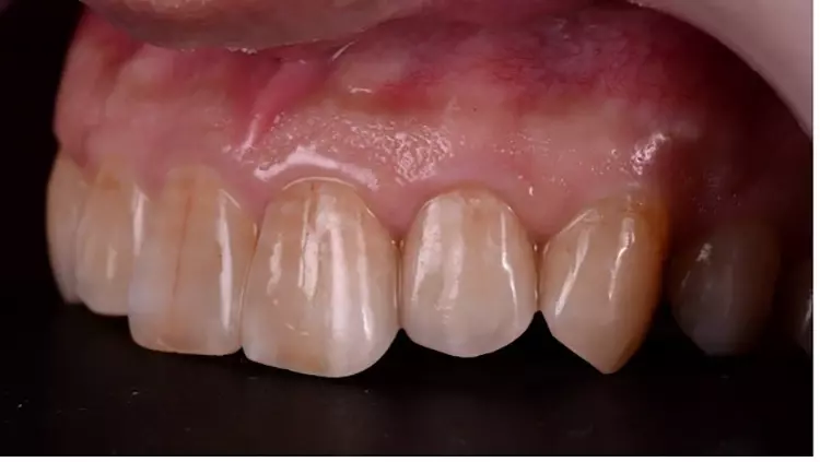 Präprothetische Extrusion und Glasfaserstiftaufbau | Dentalwelt