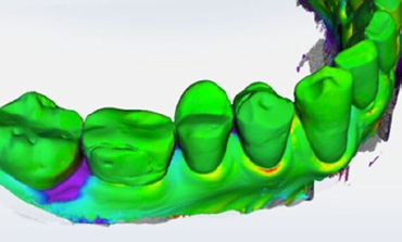 Die Diagnostik mit Intraoralscanner - das DDM | Dentalwelt