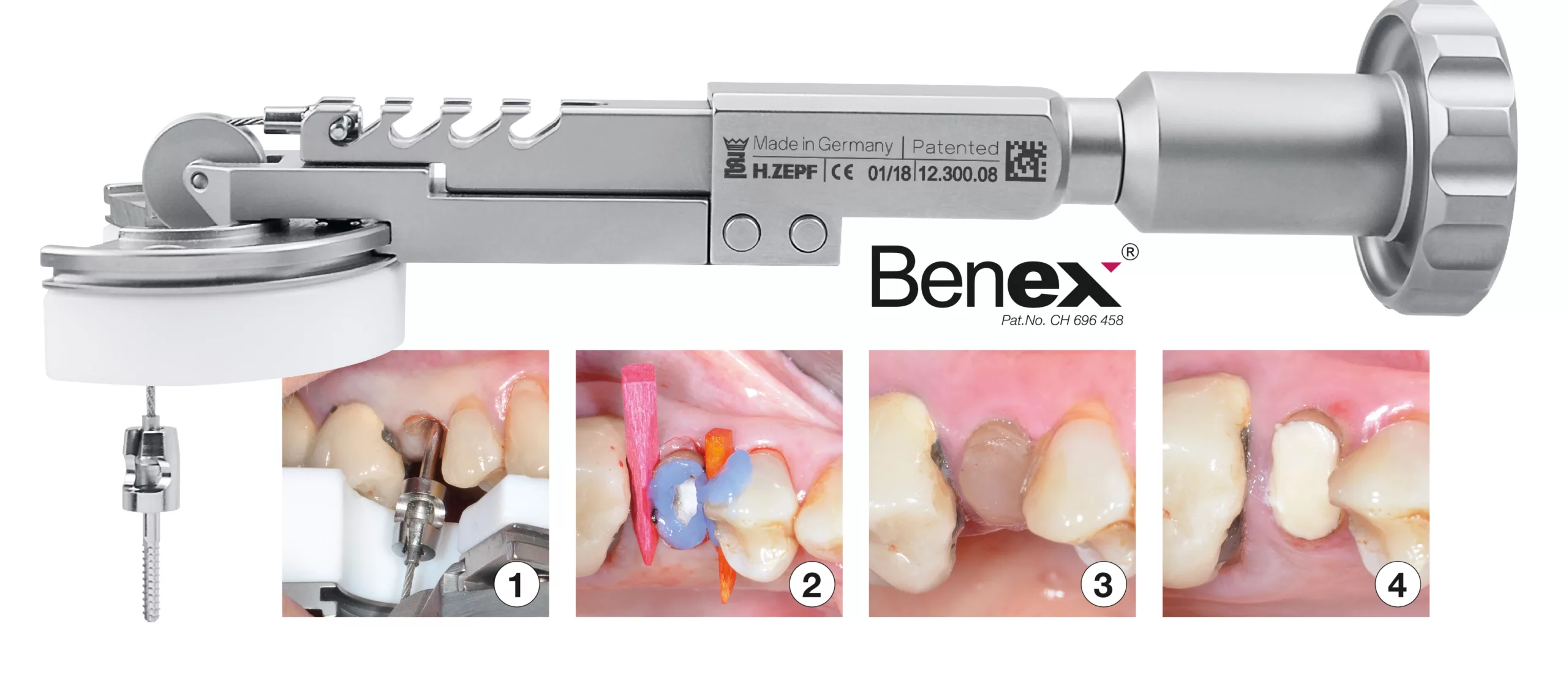 Die Kronenverlängerung mit Benex | Dentalwelt